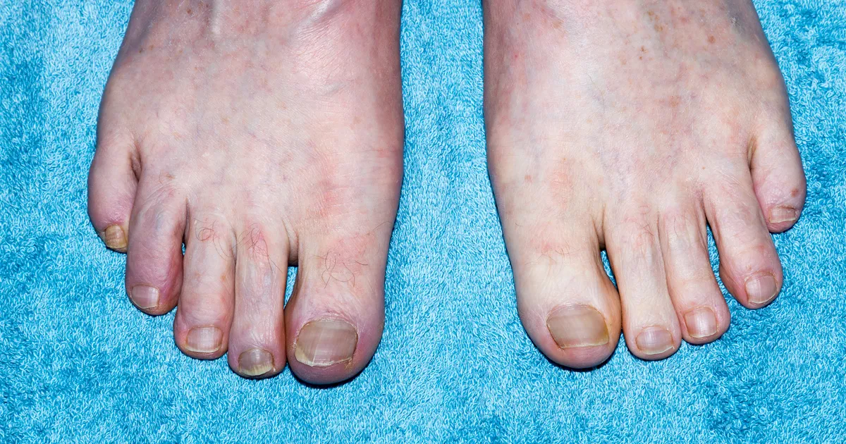 See haigus võtab alt rohkem jalgu kui maamiinid