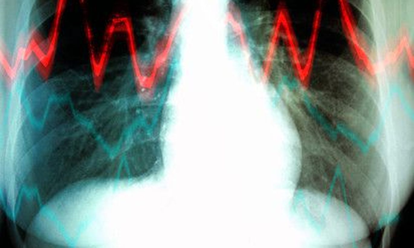 Tuberkuloosi on üha raskem diagnoosida - Tervis - 60+