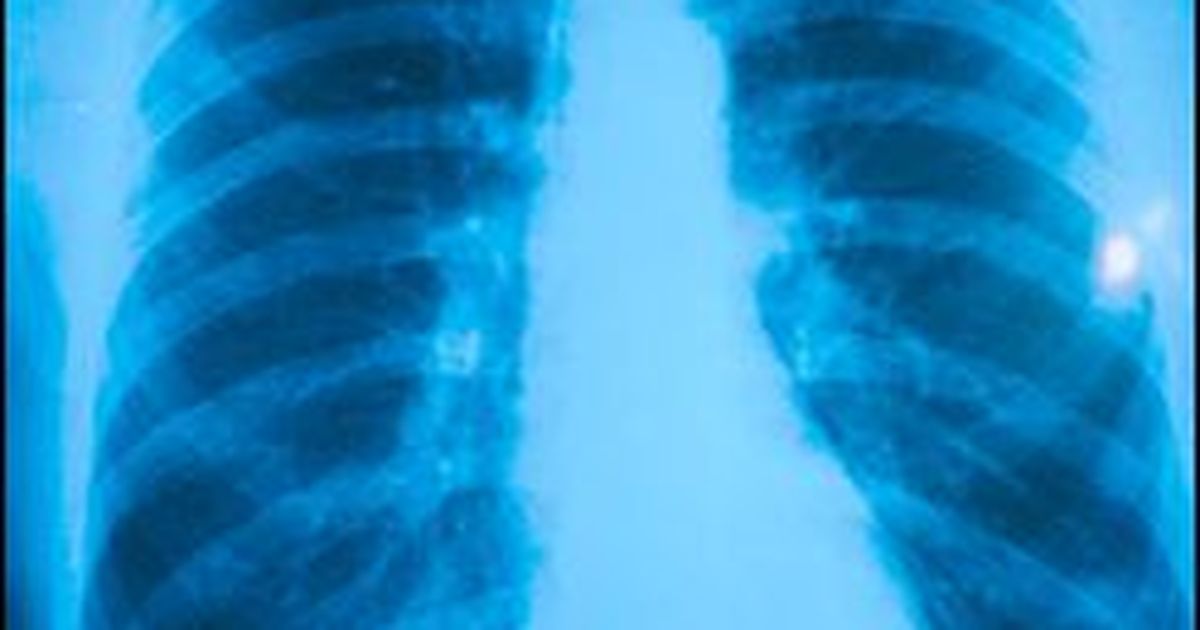 Uuringus ilmnes, miks Covid-19 korral kopsud taastumise asemel armistuvad